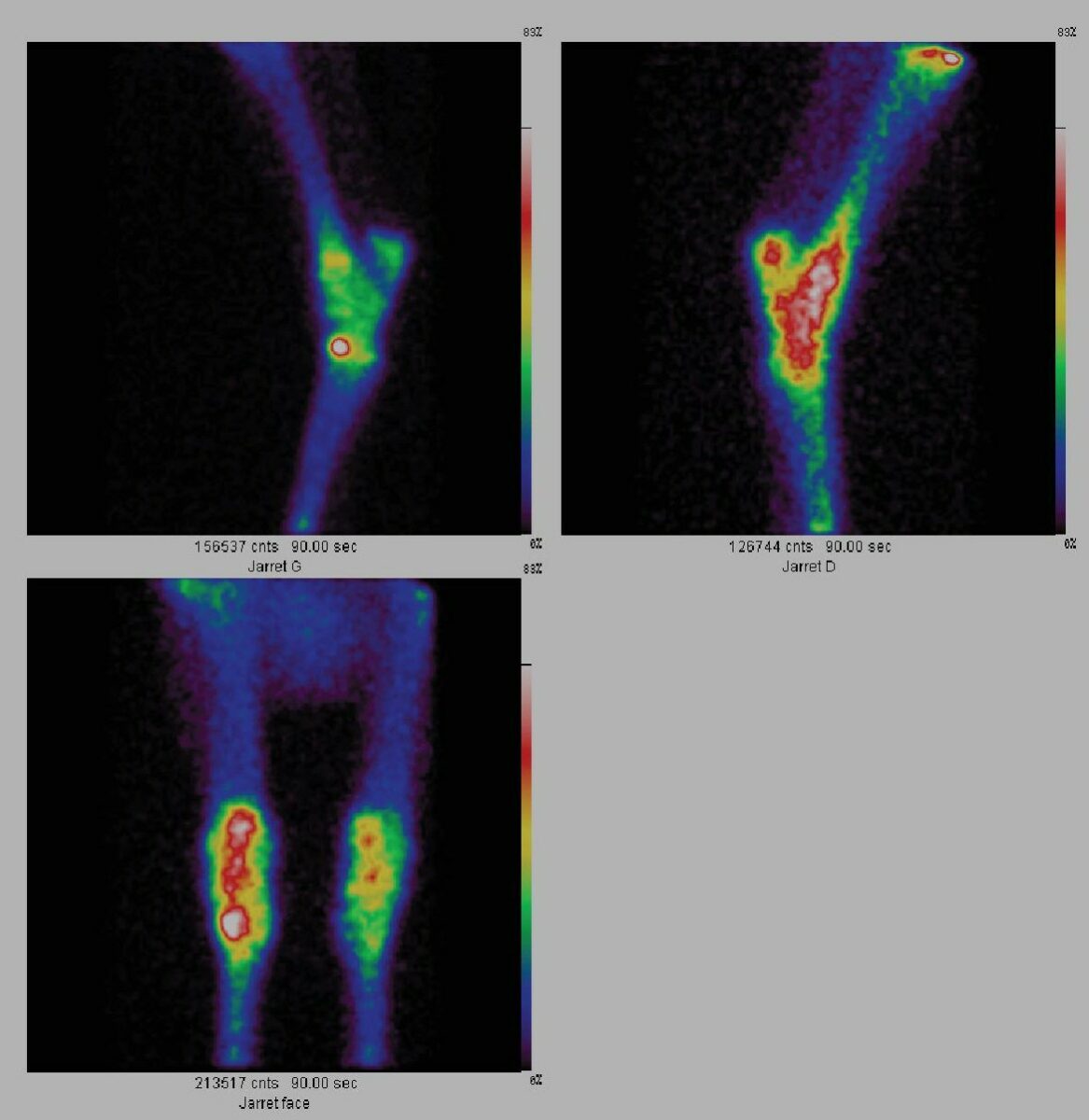 Scintigraphie - www.chve-livet.com